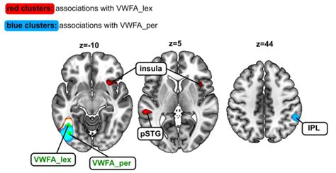 Structural Covariance Map Of Grey Matter Volume In The Lexical Part Of