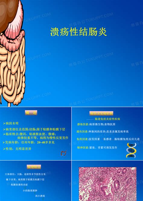 溃疡性结肠炎PPT模板下载 编号lwadzrnj 熊猫办公