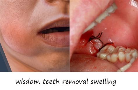 Managing Swelling After Wisdom Teeth Removal A Comprehensive Guide