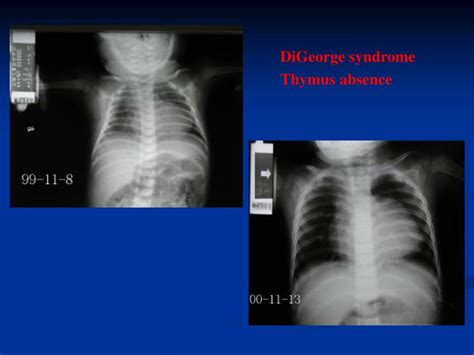 Ppt Immunodeficiency Diseases Powerpoint Presentation Free Download