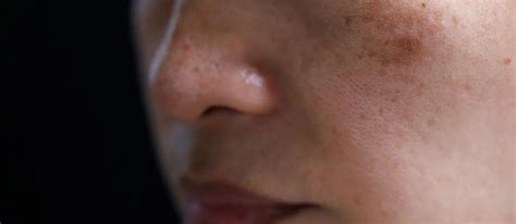 Tyrosinase Inhibitors Skincare Why Tyrosinase Inhibitors Matter