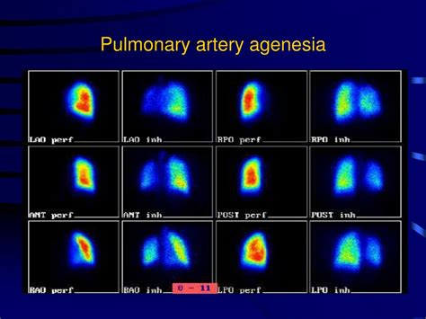 Ppt Comprehensive Guide To V Q Scintigraphy In Pulmonary Imaging Powerpoint Presentation Id