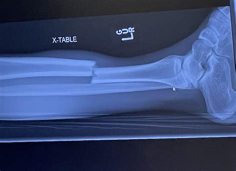 2331 Best Rrollerblading Images On Pholder Just Got Part Of My