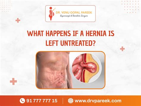 What Happens If A Hernia Is Left Untreated