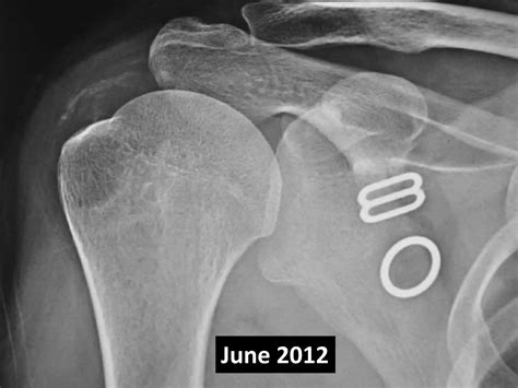 Calcific Tendinitis Of Shoulder Pptx