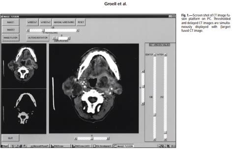 Figure 1 From Bone Image Analysis For Early Detection Of Osteoporosis Semantic Scholar