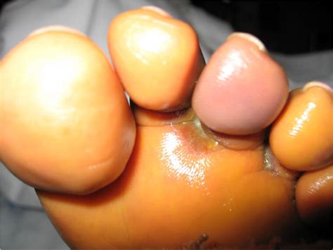 Interdigital Intertrigo With Cellulitis Courtesy Of Dr Marcia Matos Download Scientific