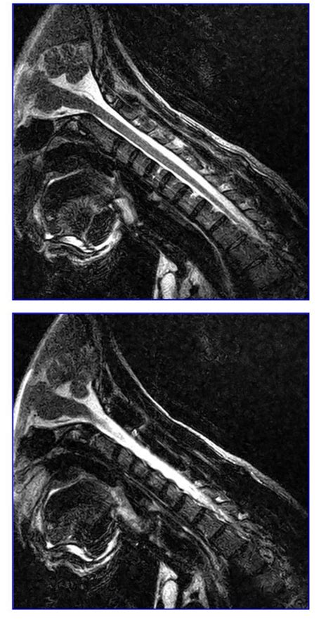 Nerve Or Spine Compression R Spinesurgery