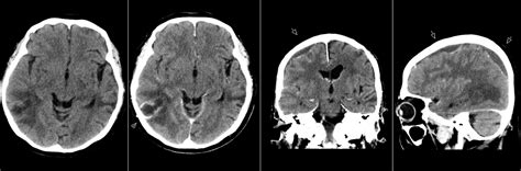 Abscess And Subdural Empyema