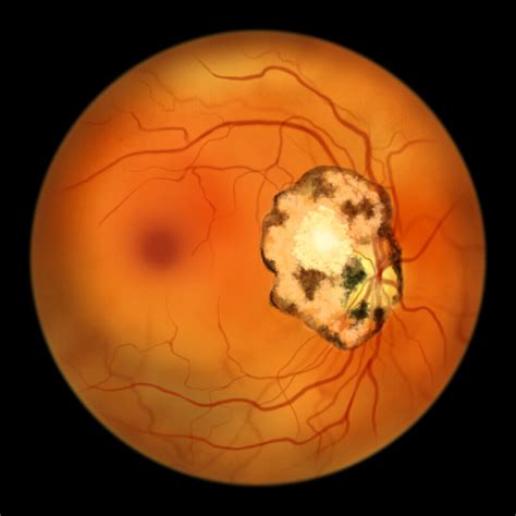 Retinal Scar Caused By Toxoplasmosis … Acheter Une Photo 13956087 Science Photo Library