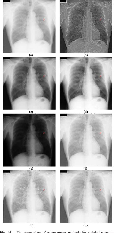 Figure 14 From X Ray Enhancement Based On Component Attenuation Contrast Adjustment And Image