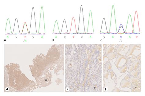 Figure 1 From Hyperfunctioning Papillary Thyroid Carcinoma With A Braf Mutation The First Case