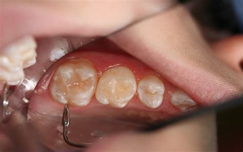 Caries Prevention Sealants Smiles For Life Oral Health