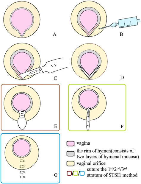 What Is The Hymen Layer