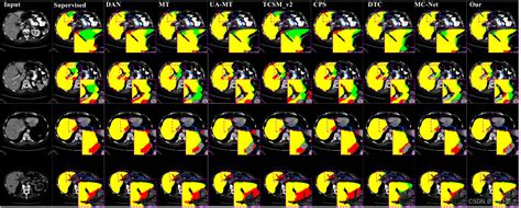 【医学分割】semi Supervised Medical Image Segmentation Network Ase Netsemi Supervised Medical Image