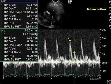 Vegetative Endocarditis Members