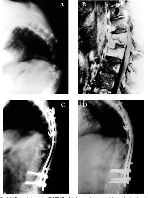 Figure 1 From Surgical Treatment Of Spinal Pseudoarthrosis In Ankylosing Spondylitis Semantic