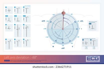 When Electrical Axis Electrocardiogram Severely Left Stock Illustration Shutterstock