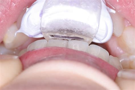 The Dawson Academy On Linkedin Occlusal Splint Therapy For Tmj Tmj Splint Therapy Course