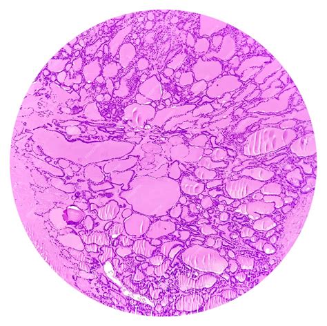 Premium Photo Synovial Sarcoma Histology Image Analyzed By Light Microscope At Histopathology