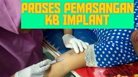 Kb Spiral Iud Kenali Dulu Jenis Efek Dan Cara Pemasangannya