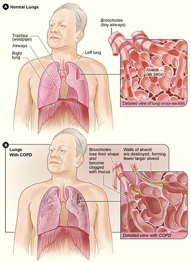 Asthma Vs COPD Difference And Comparison Diffen