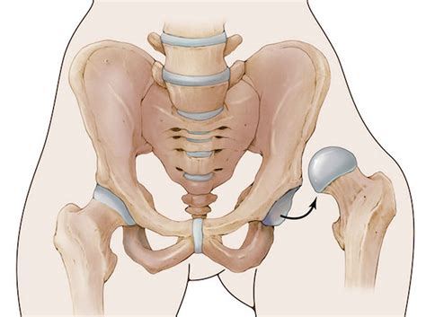 Hip Dislocation Causes Symptoms Diagnosis Treatment And Recovery