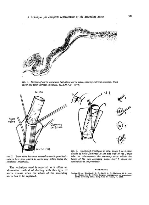 A Technique For Complete Replacement Of The Ascending Aorta Pmc