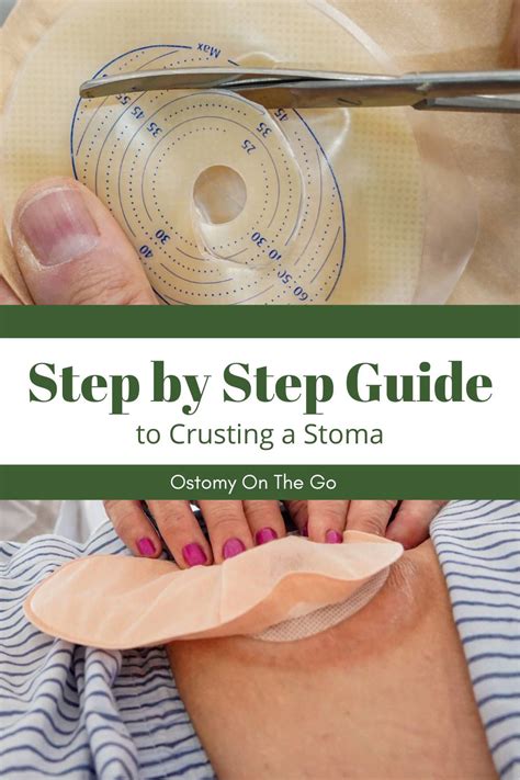 Stoma Crusting Technique Step By Step Guide Ostomyonthego