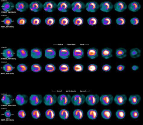 SPECT MPI Of A Year Old Woman Presenting With Shortness Of Breath Download Scientific
