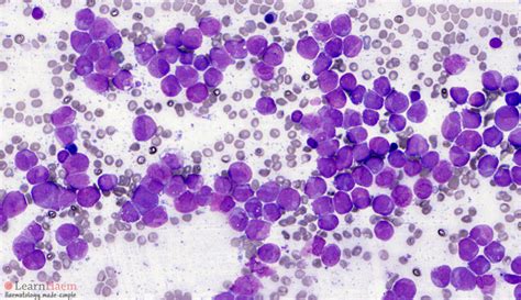 Acute Promyelocytic Leukaemia Apml Learnhaem Haematology Made Simple