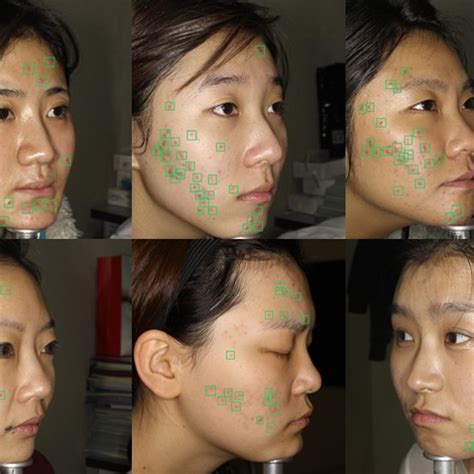 Qualitative Detection Results Of Our Method On The Acne04 Testset