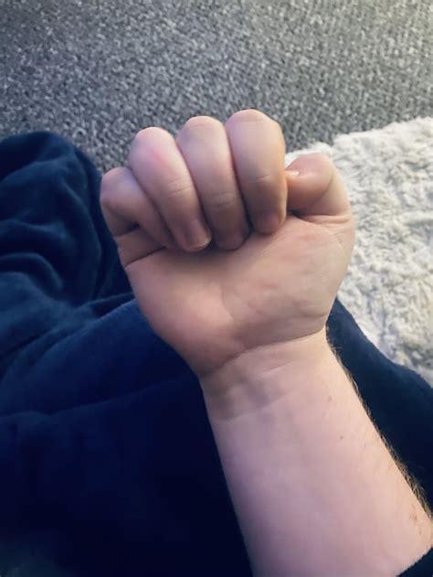 Broke My 5th Metacarpal R Medical Advice