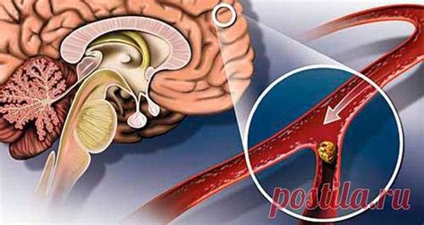 Улучшаем мозговое кровообращение — СОВЕТНИК Для дома Постила