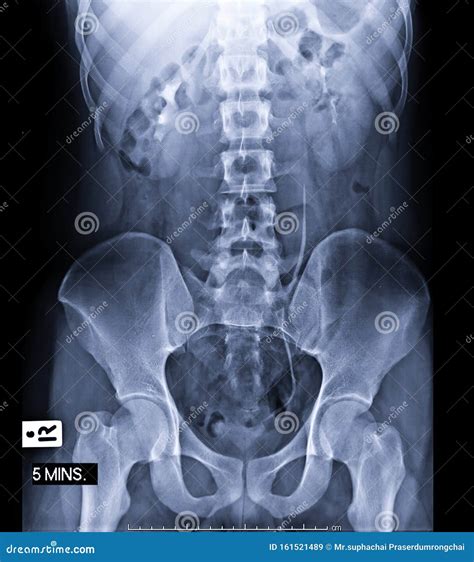 Comparison Of Intravenous Pyelogram Or I V Stock Image Image Of Examination Excretory 161521489