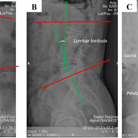 Measuring Method Of Cobb Angle A Lumbar Lordosis B And Sacral Download Scientific Diagram