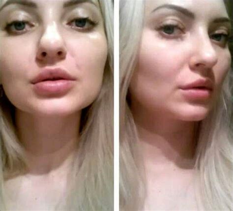 Rf Before And After Photos 14 Facelift Info Prices Photos