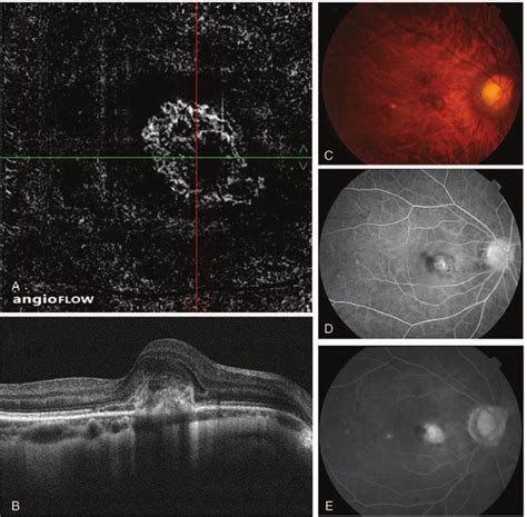Choroidal Neovascularization Cnv Caused By Pathological Myopia Pm Download Scientific