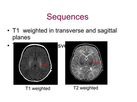 Mri Neonatal Brain 1 Ppt