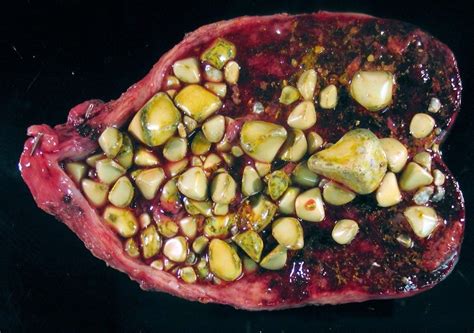 Лечение Камней В Почках Фото — Картинки фотографии