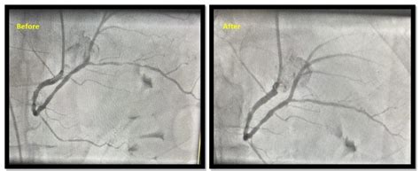 Lm Stent Longitudinal Deformation Saudi Arabian Cardiac
