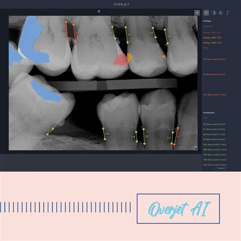 Ufcd And Overjet Partner To Develop Dental Ai Education Program College