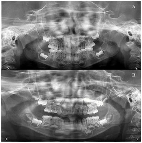 The Initial And Final Radiographs A Pre Treatment B Post Treatment Download