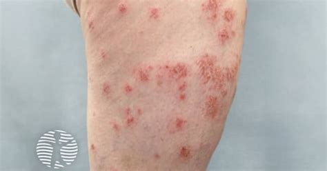Nummular Dermatitis Discoid Eczema Image
