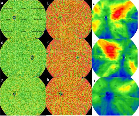 Towardpi On Linkedin Quantitative Analysis Of Choroidal Vasculature In Central Serous…