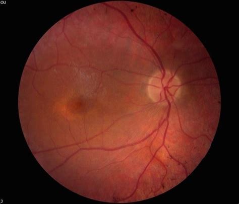 “neuralink Is Working On A Vision Chip” Elon Musk Rophthalmology “neuralink Is Working On A Vision Chip” Elon Musk Rophthalmology