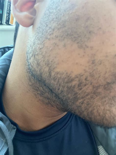 Really Self Conscious About My Patchy Beard Is It Beard Alopecia R