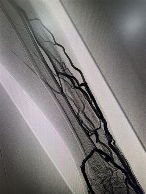 Lijesh Kumar On Linkedin Avfistula Savethefistula Endovascular Interventionalradiology