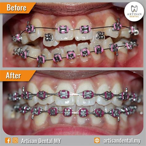 Conventional Braces Artisan Dental