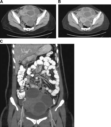 Laparoscopic Ovarian Cystectomy Cpt Cpt 58662 Is The Laparoscopic Ovarian Cystectomy For Simple